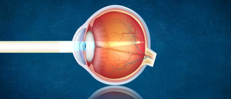 Nachstar-Lasern mit YAG-Laser · AUGENZENTRUM Wien 14